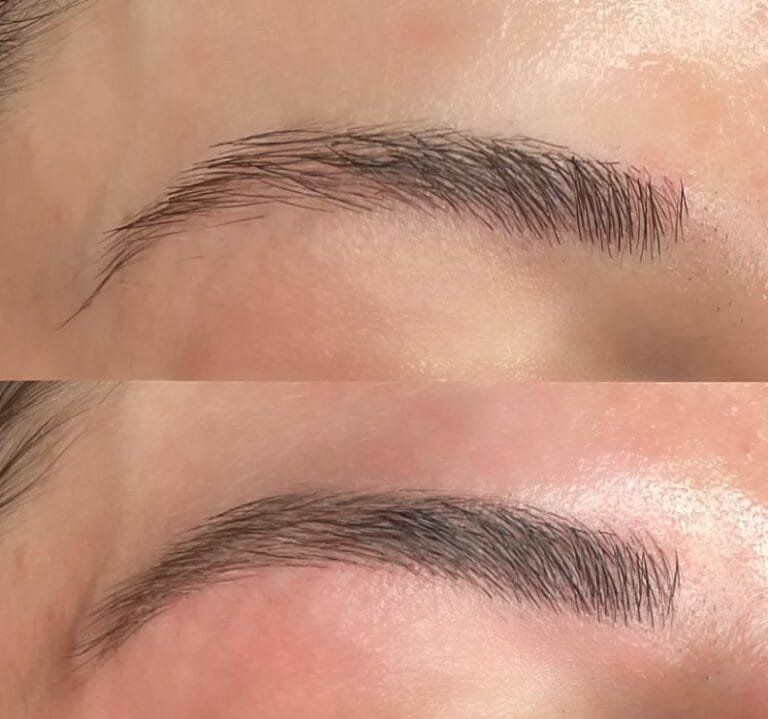 Eyebrow Tattoo Laser Removal | Embrace Your Natural Brows